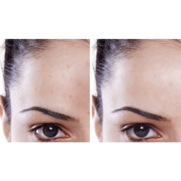 AquaGlo Hydradermabrasion System | Comfortel