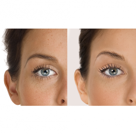 AquaGlo Diamond Hydradermabrasion System - Comfortel